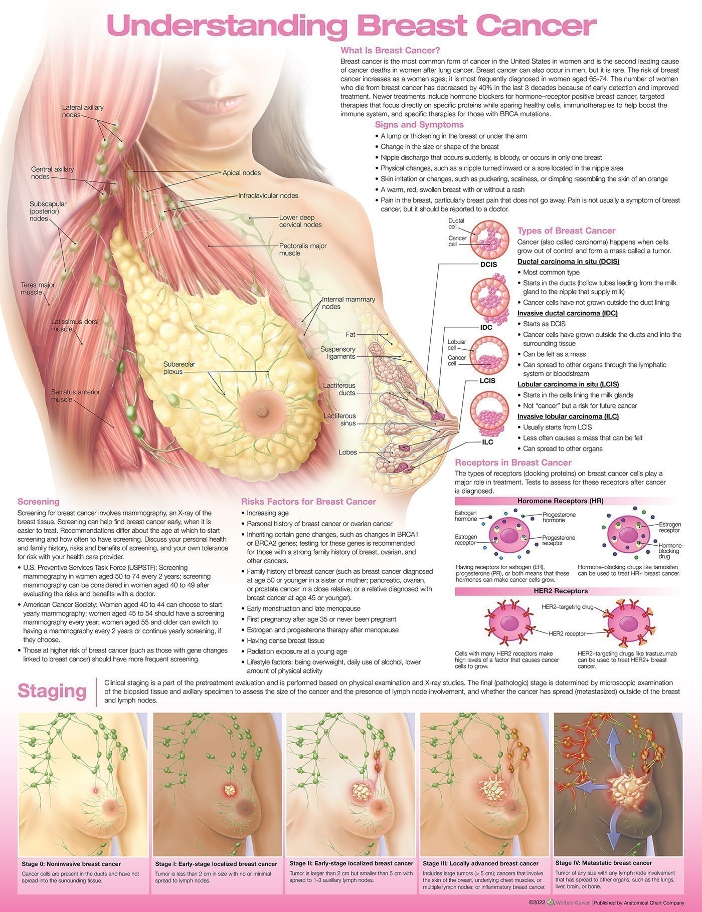 Anatomy Charts & Posters > Understanding Breast Cancer Anatomical Chart ...